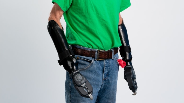 How Do Prosthetic Hands Work? - Pongratz Orthotics & Prosthetics